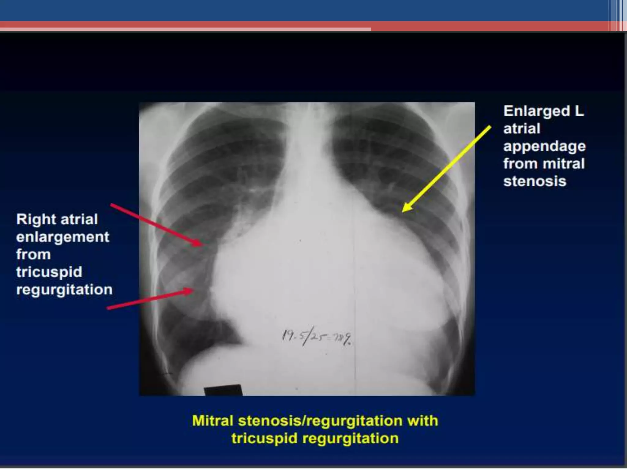 Mitral valve disease 2020 | PPT