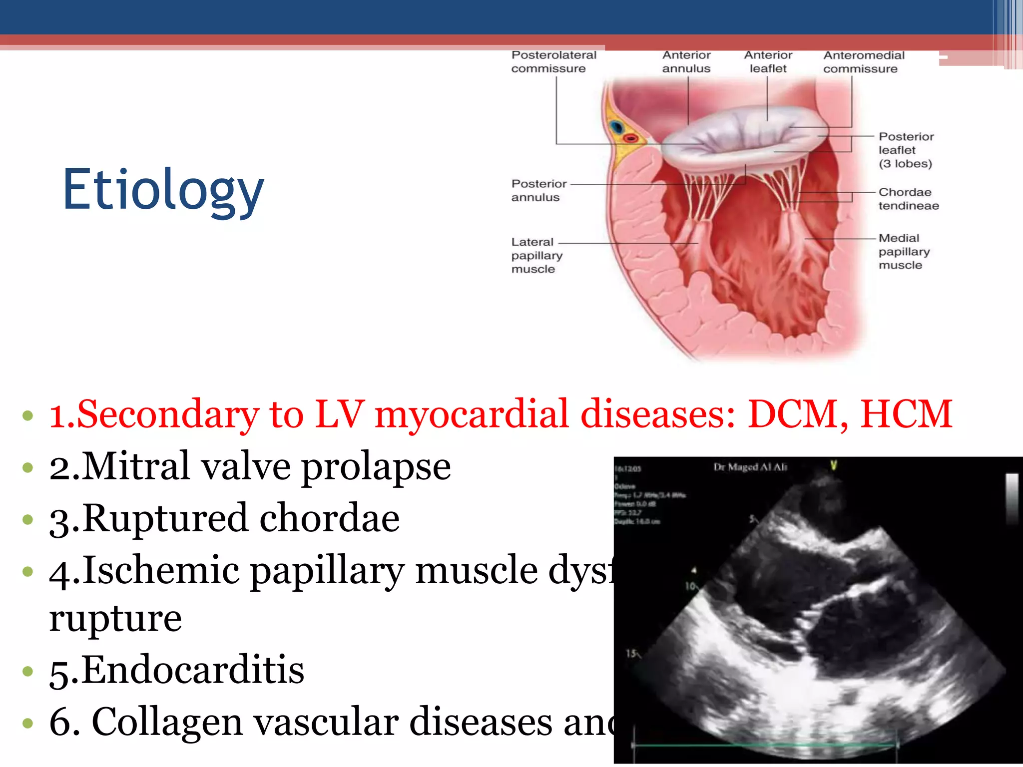 Mitral valve disease 2020 | PPT