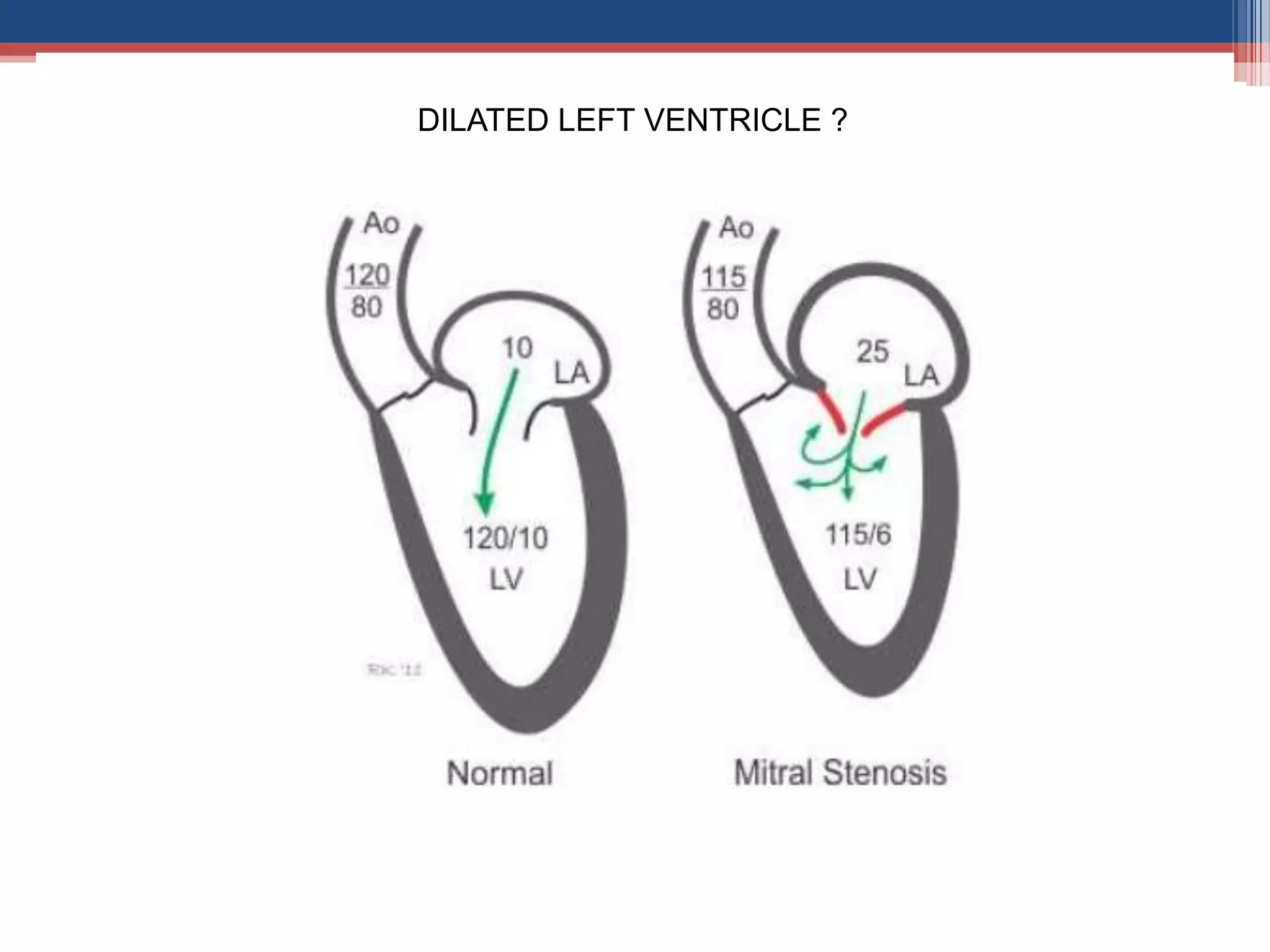 Mitral valve disease 2020 | PPT