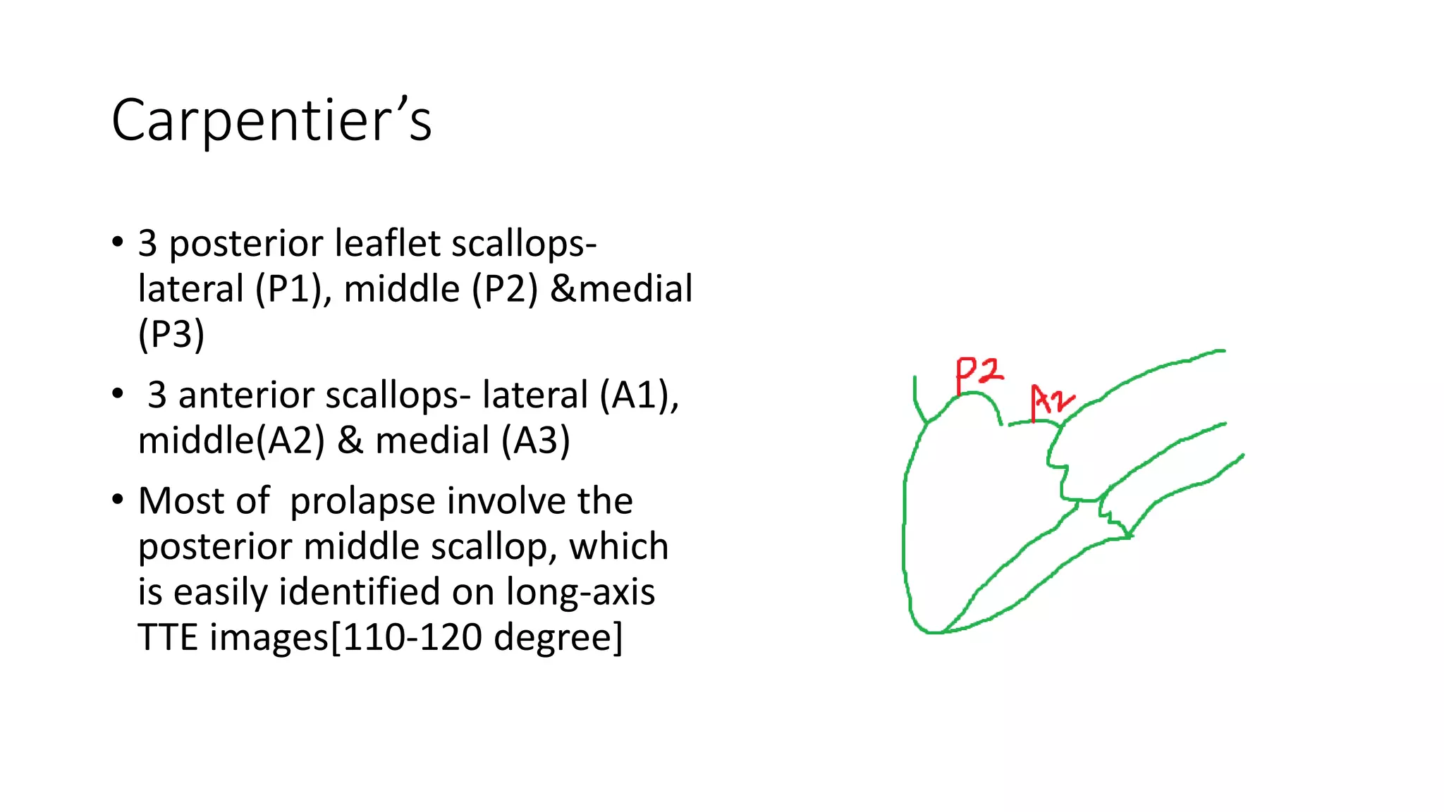 Mitral valve prolapse | PPTX