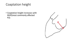 Mitral valve prolapse | PPTX