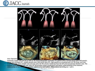 Mitral valve prolapse | PPTX