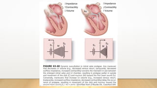 Mitral valve prolapse | PPTX