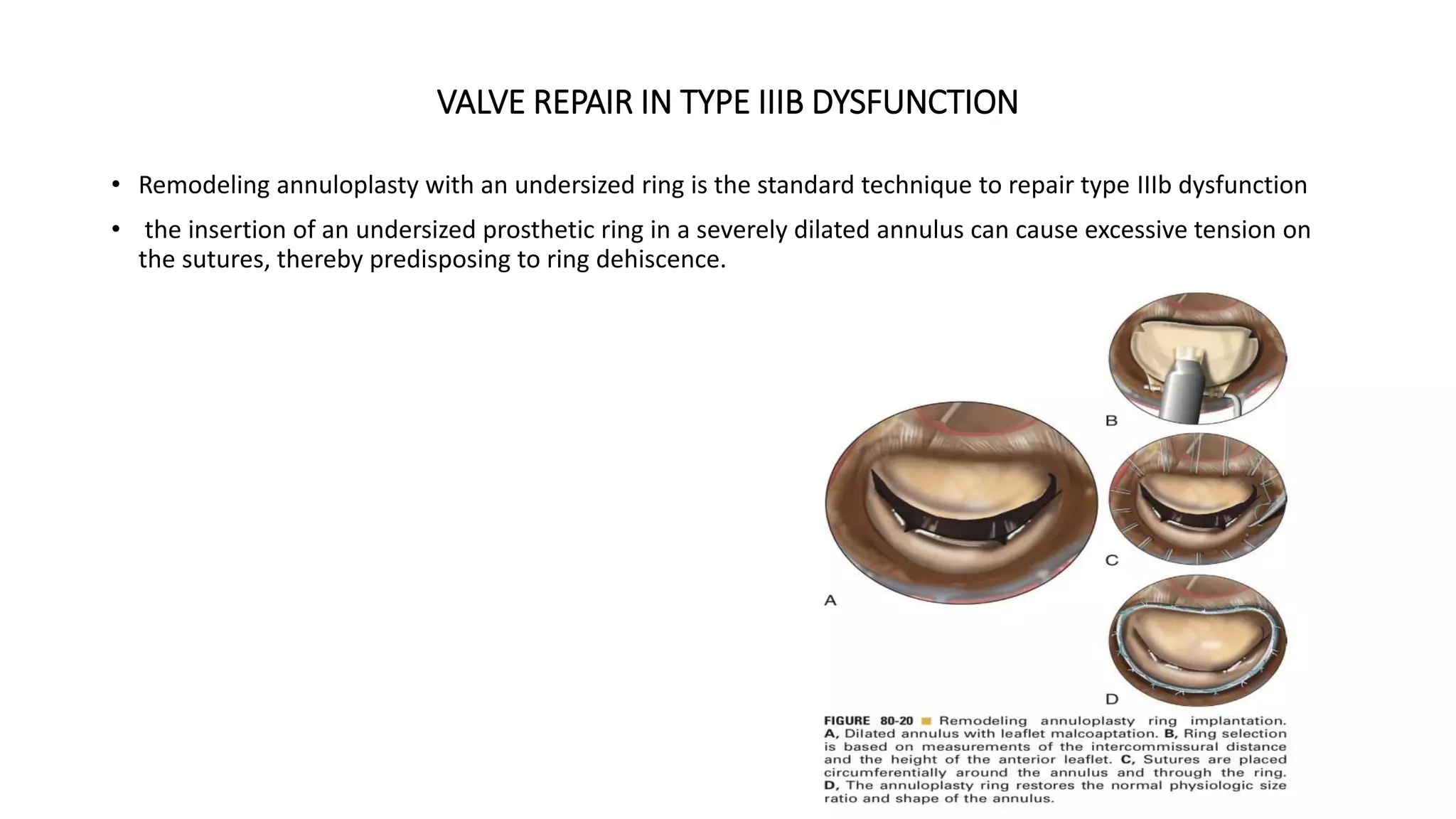 Mitral valve repair | PPTX