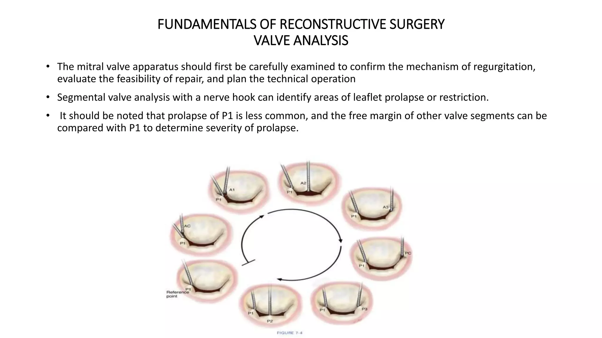 Mitral valve repair | PPTX