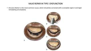 Mitral valve repair | PPTX