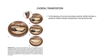 Mitral valve repair | PPTX