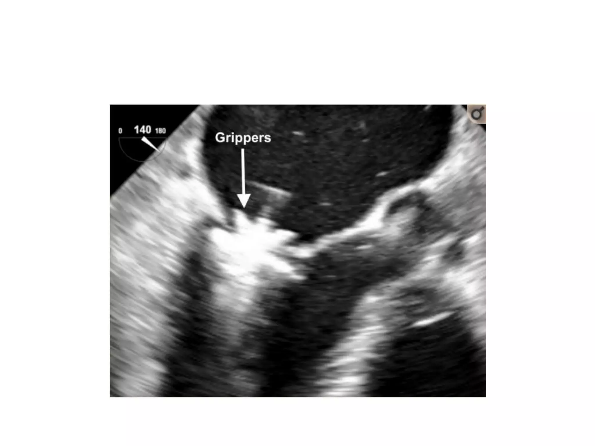 Mitral valve repair//TRANSCATHETER MITRAL VALVE REPAIR/ TRANSCATHETER ...