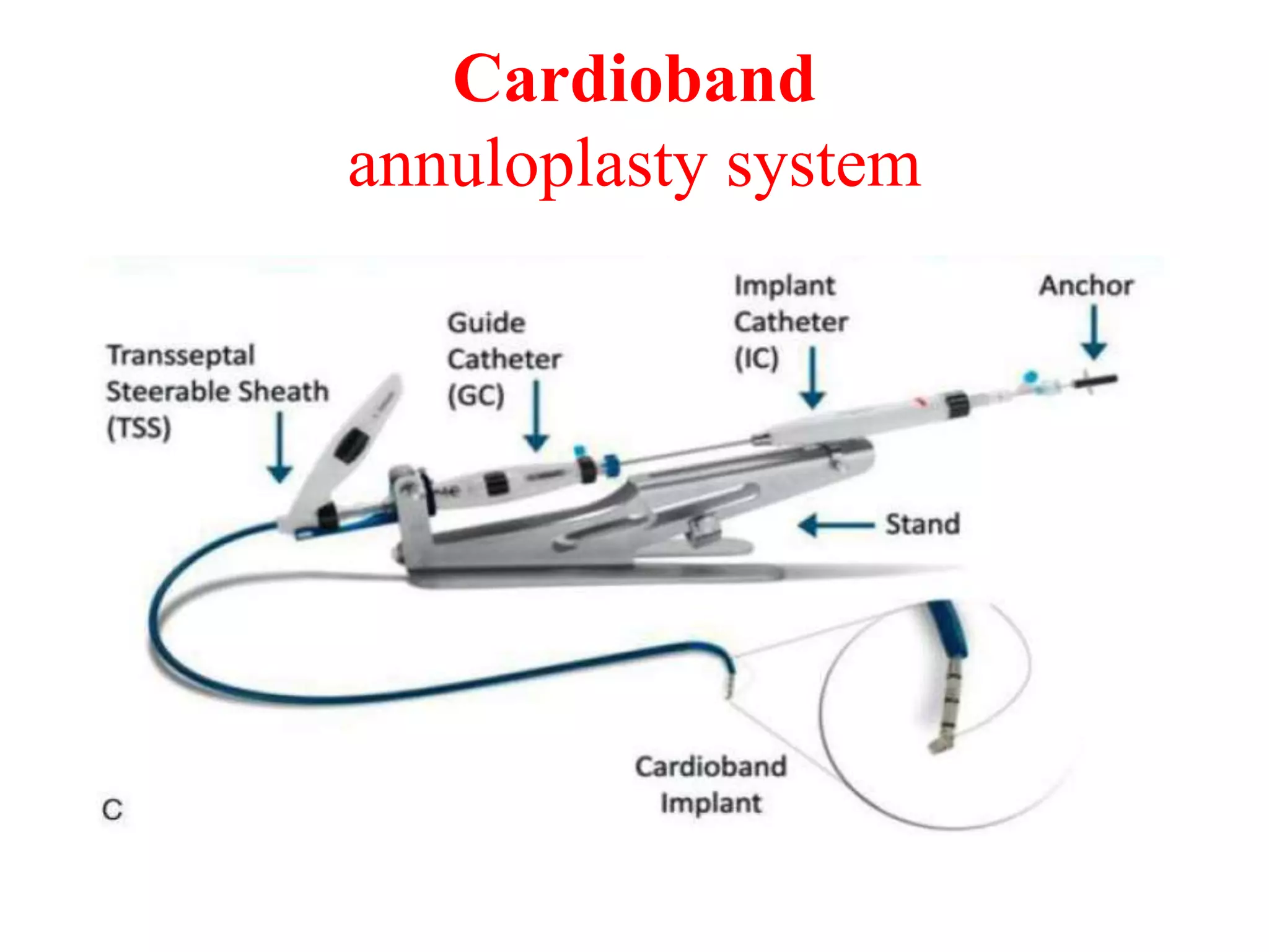 Mitral valve repair//TRANSCATHETER MITRAL VALVE REPAIR/ TRANSCATHETER ...