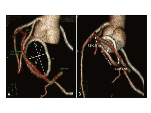 Mitral valve repair//TRANSCATHETER MITRAL VALVE REPAIR/ TRANSCATHETER ...