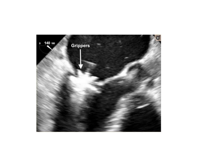Mitral valve repair//TRANSCATHETER MITRAL VALVE REPAIR/ TRANSCATHETER ...