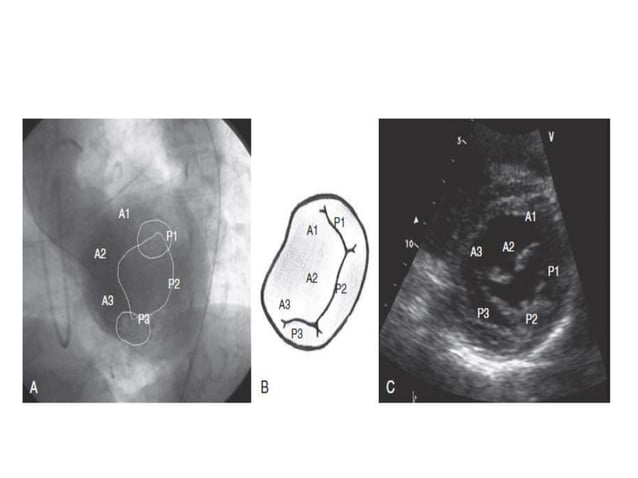 Mitral valve repair//TRANSCATHETER MITRAL VALVE REPAIR/ TRANSCATHETER ...