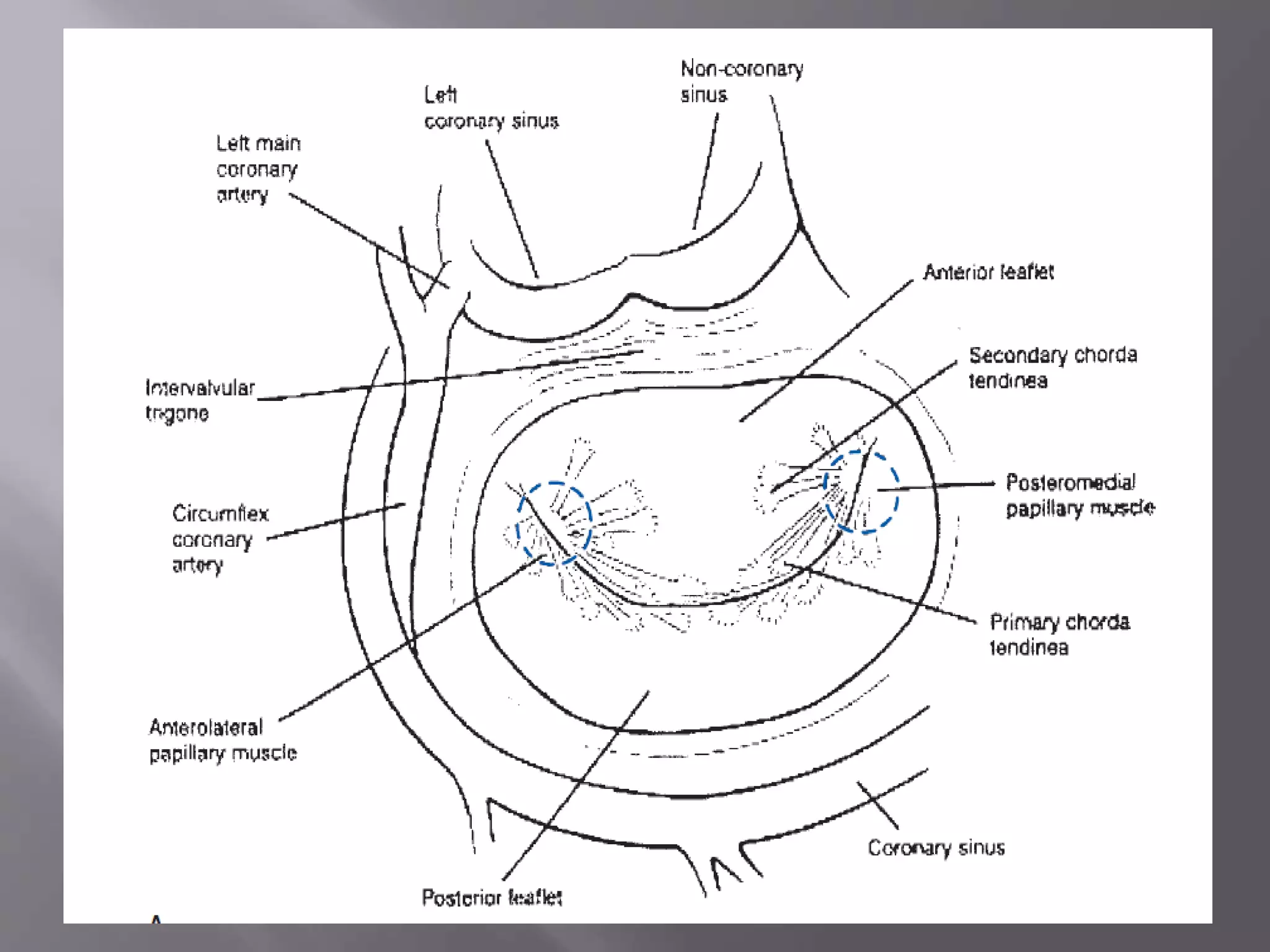 Mitral valve repair and related aspects | PPTX