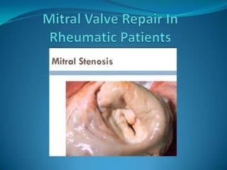 Mitral valve repair in rheumatic patients | PPTX