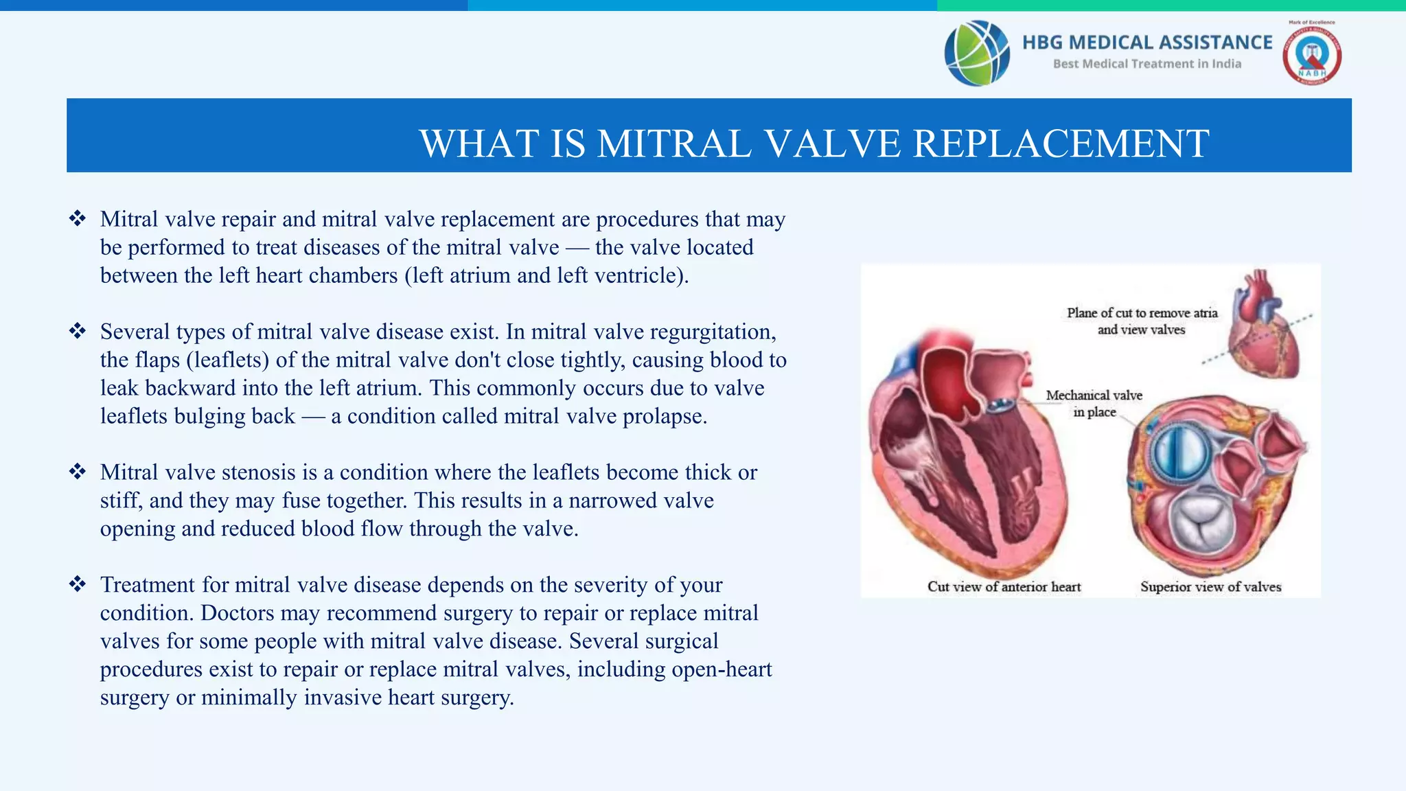 Mitral Valve Replacement Surgery in India | PPTX