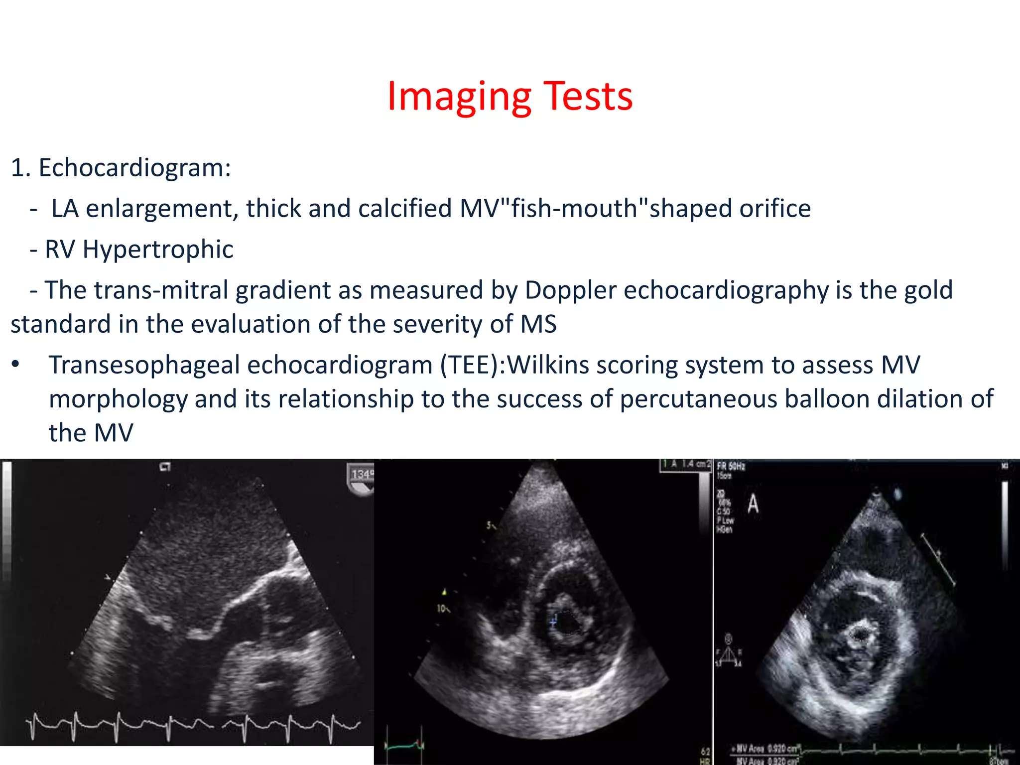 Mitral valve stenosis | PPTX