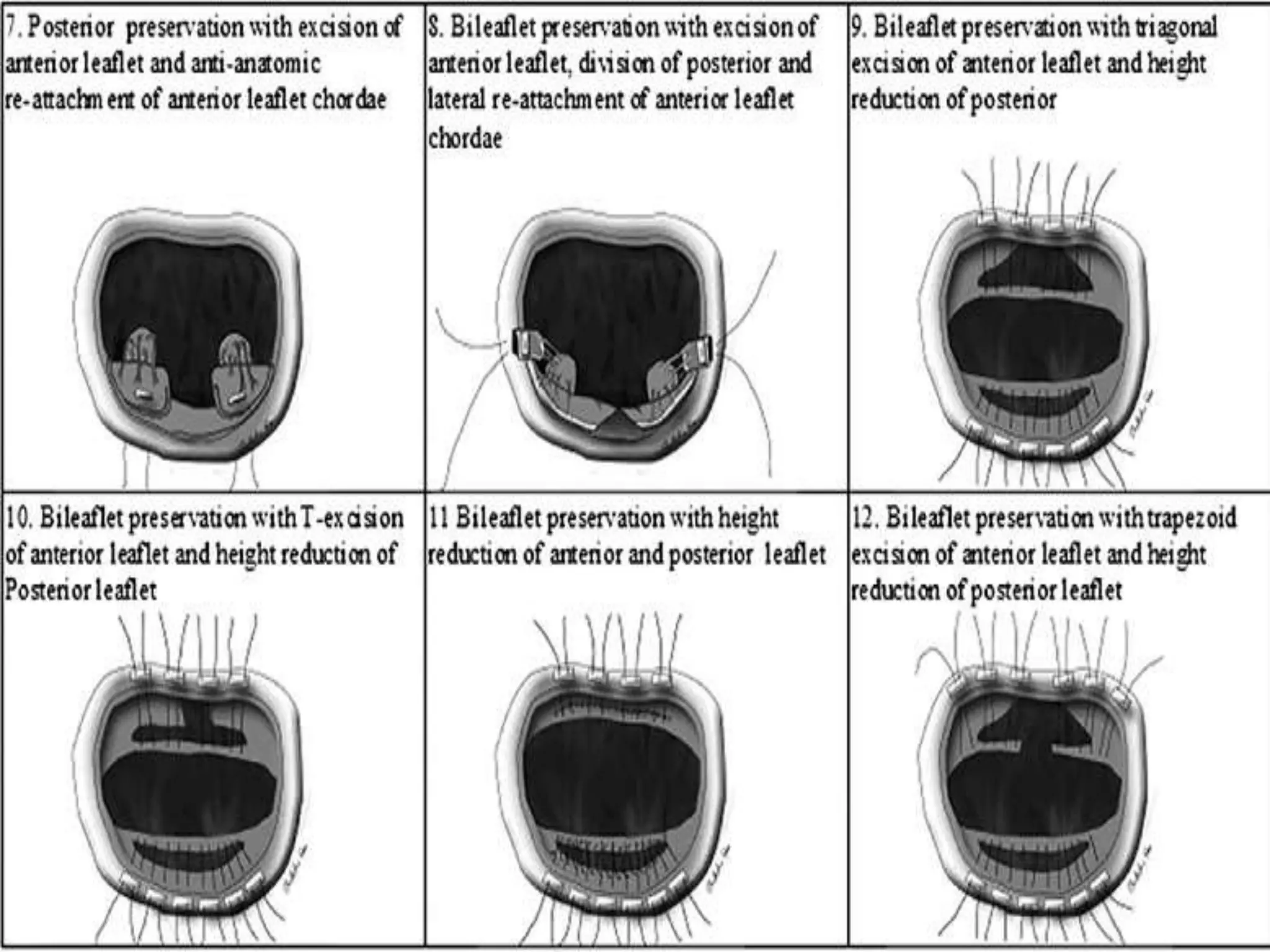 Mitral valve surgery chordal preservation | PPTX