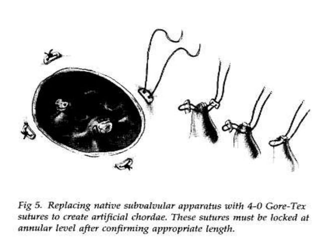 Mitral valve surgery chordal preservation | PPTX