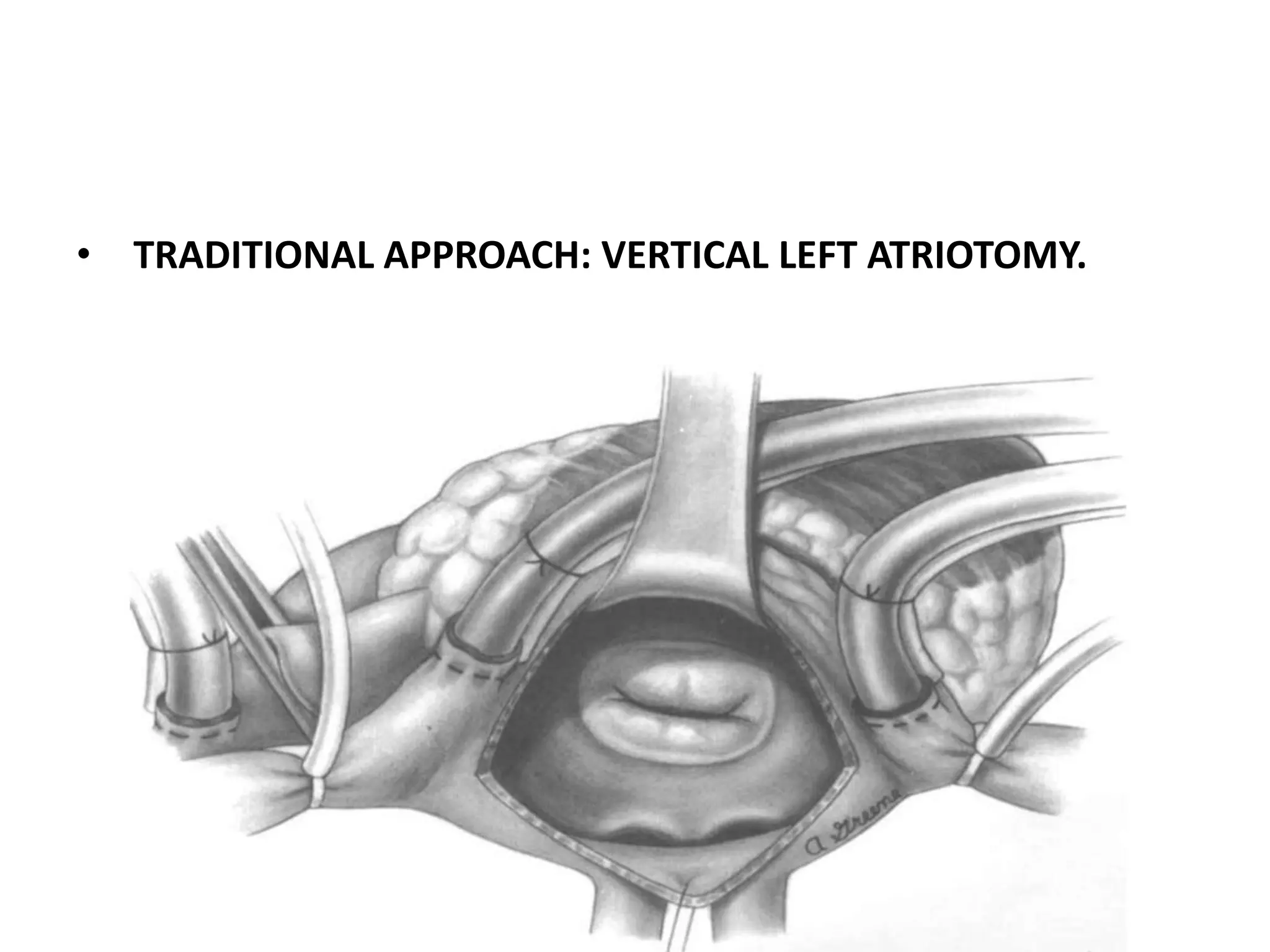 Mitral valve surgical treatment | PPTX