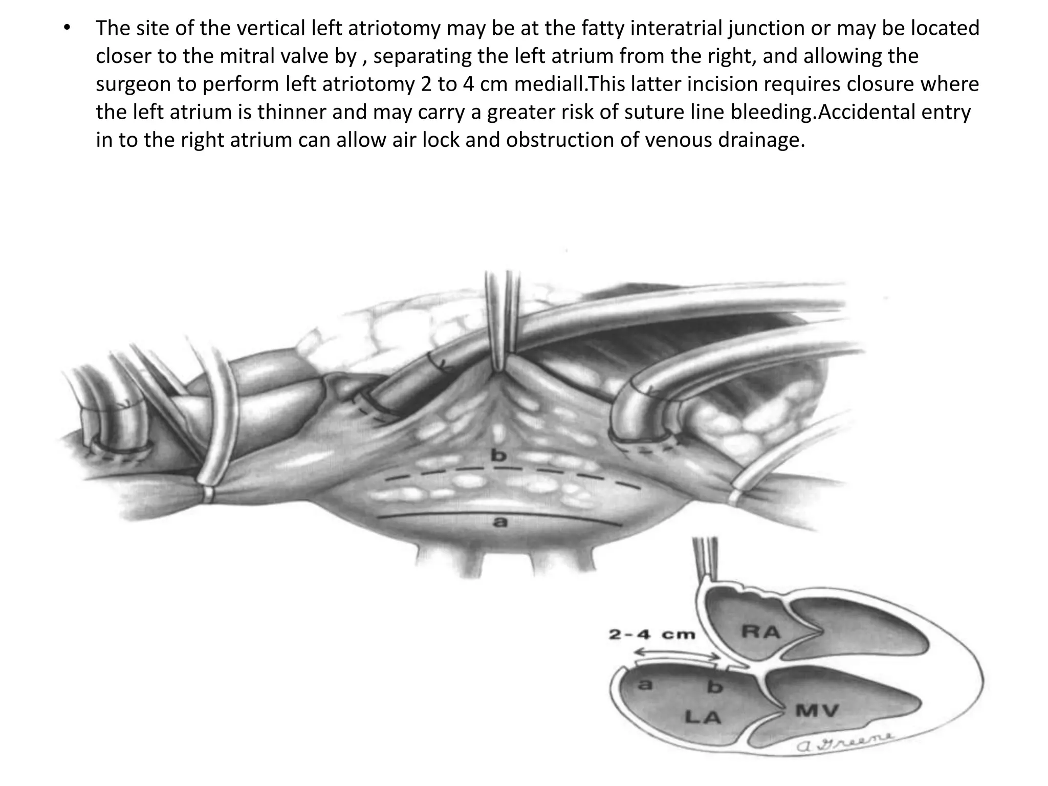 Mitral valve surgical treatment | PPTX