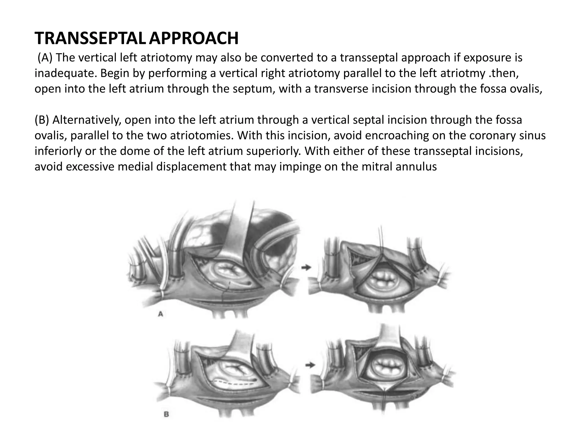Mitral valve surgical treatment | PPTX