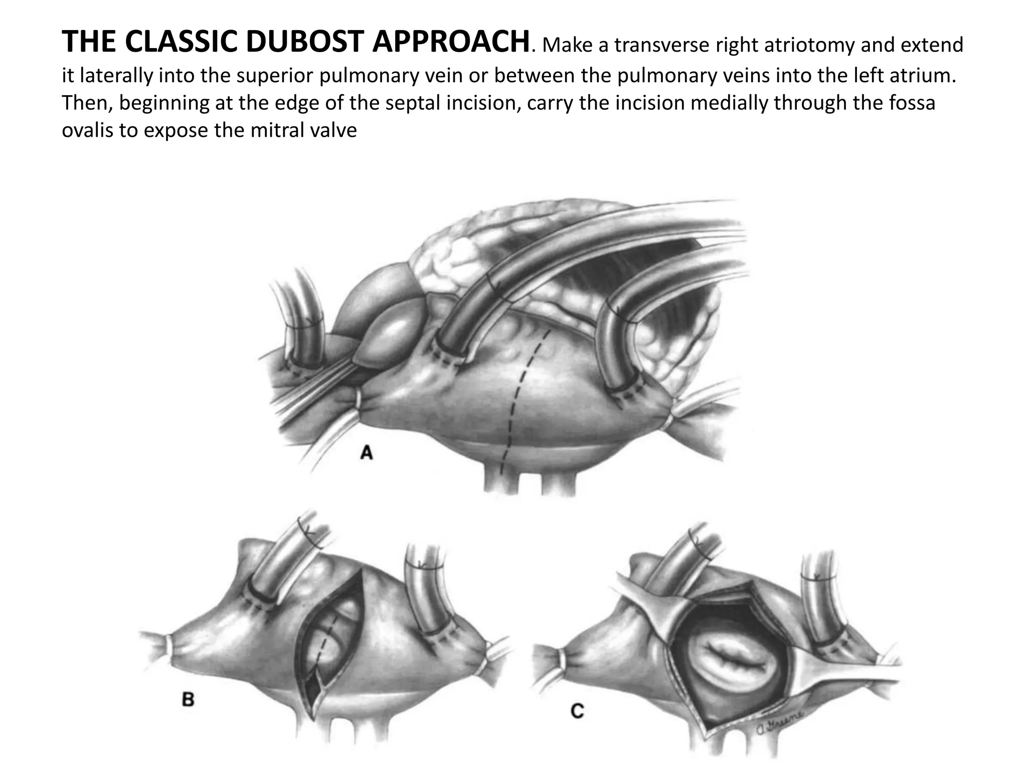 Mitral valve surgical treatment | PPTX