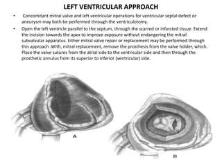 Mitral valve surgical treatment | PPTX