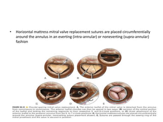 Mitral valve surgical treatment | PPTX