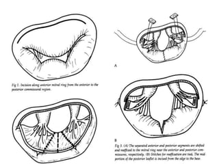 Mitral valve surgical treatment | PPTX