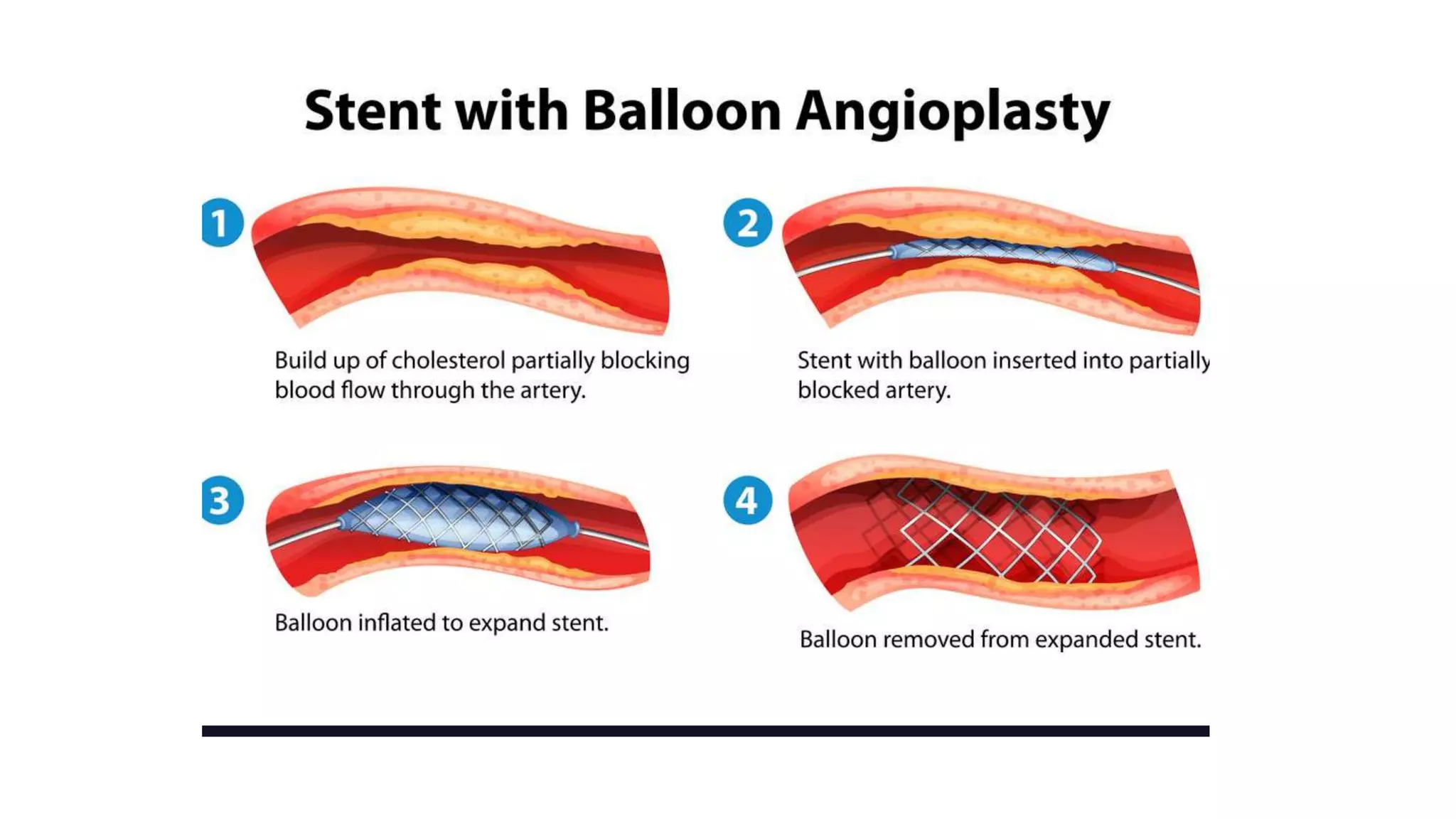 Myocardial infarction treatment | PPTX | Heart and Cardiovascular ...