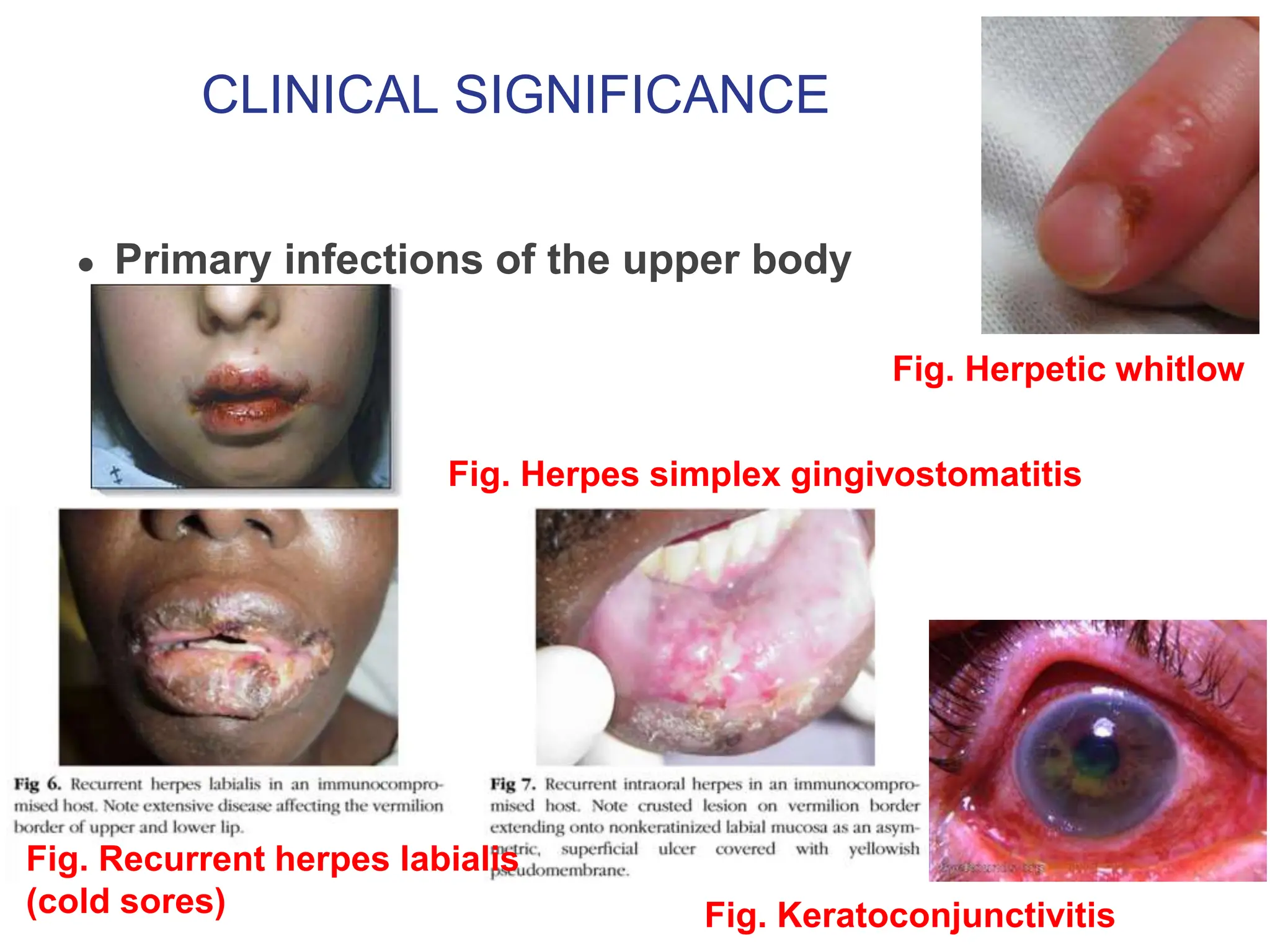 HERPES SIMPLEX VIRUS 12032019 TUESDAY pptx | PPTX