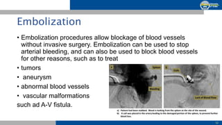 Minimal invasive vascular surgery | PPTX | Blood Disorders | Diseases ...