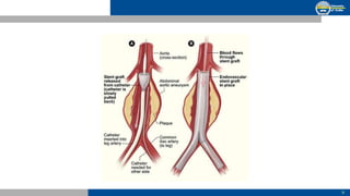 Minimal invasive vascular surgery | PPTX