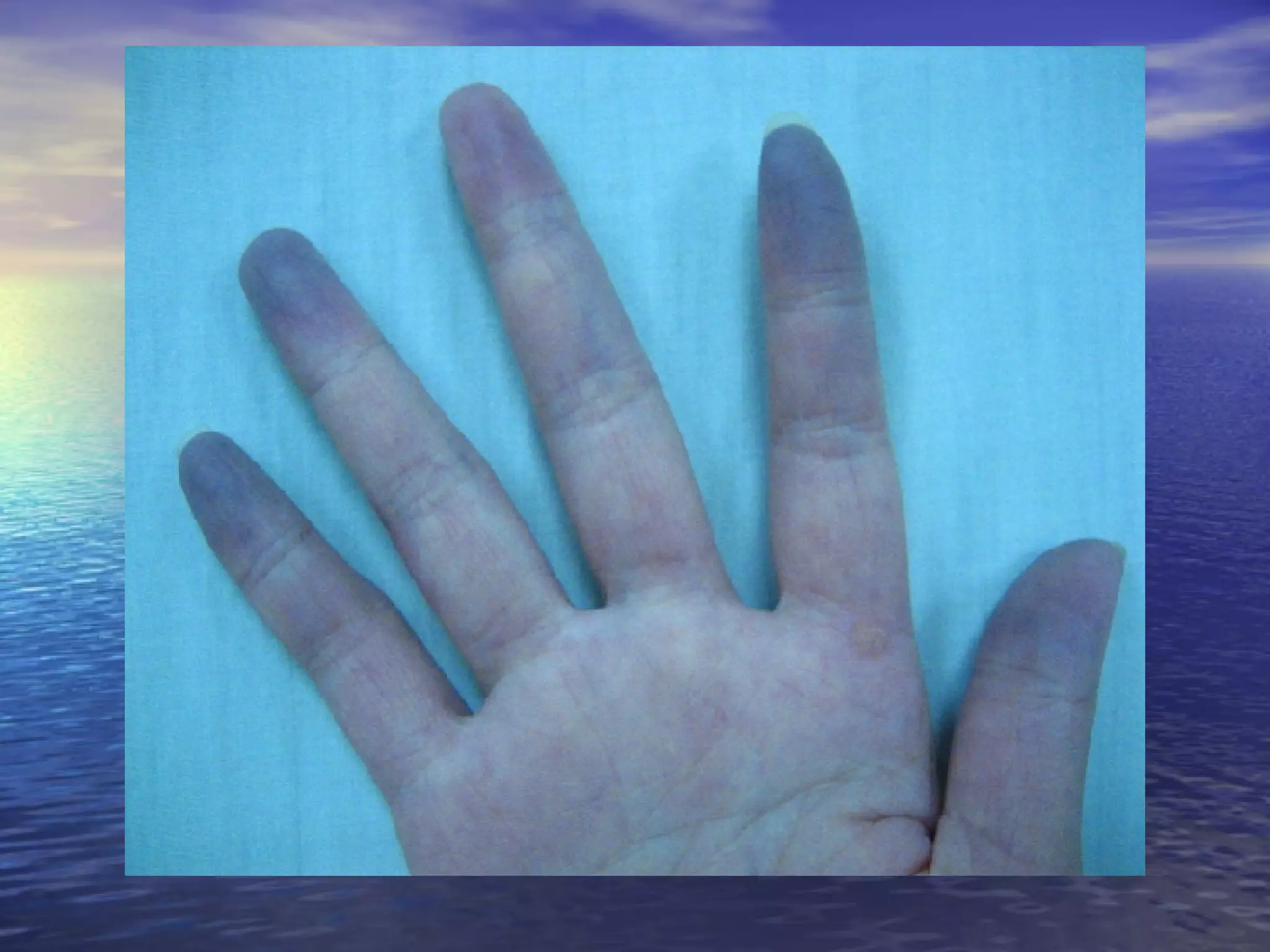 Mixed Connective Tissure Disease | PPT