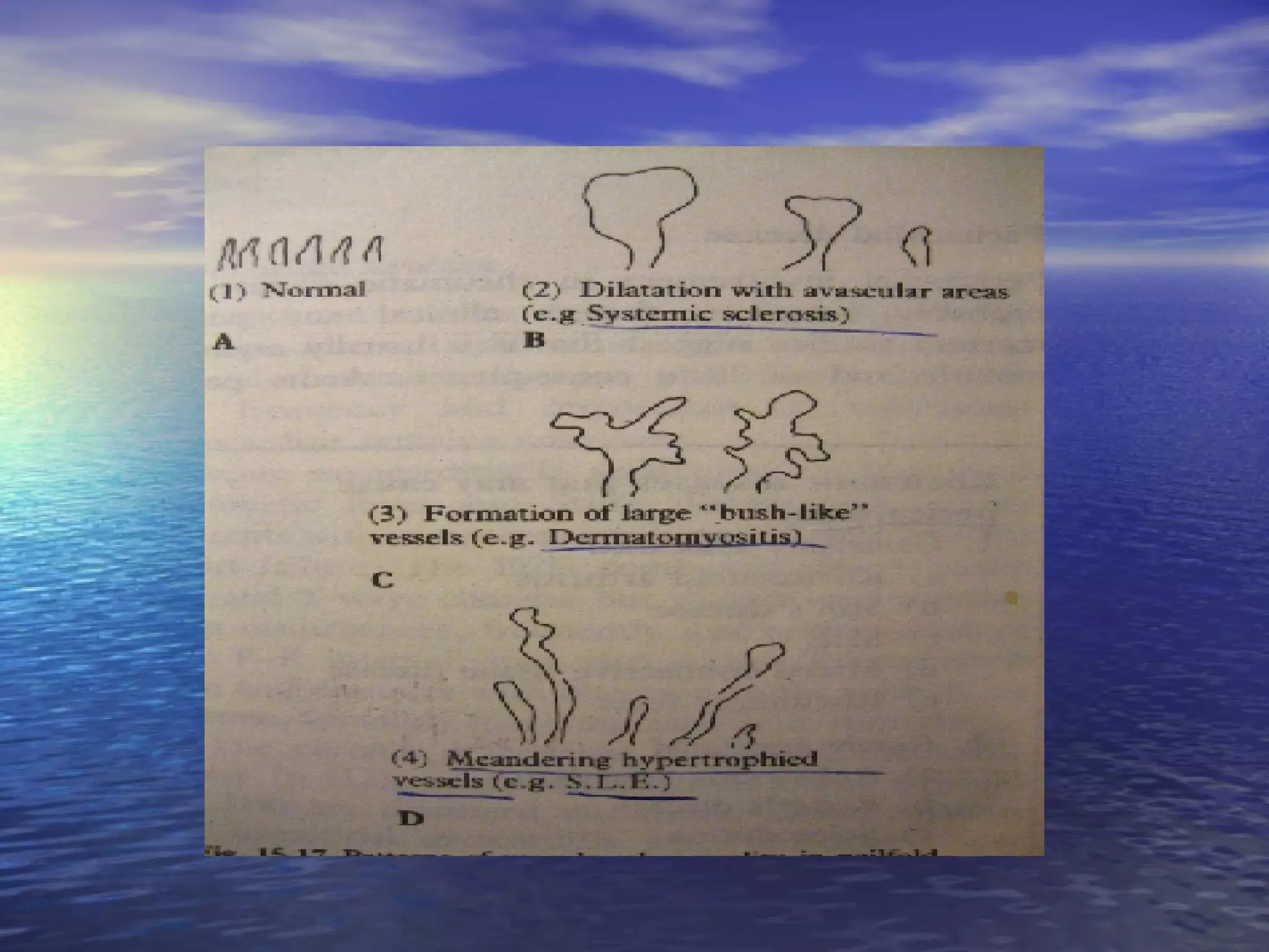 Mixed Connective Tissure Disease | PPT