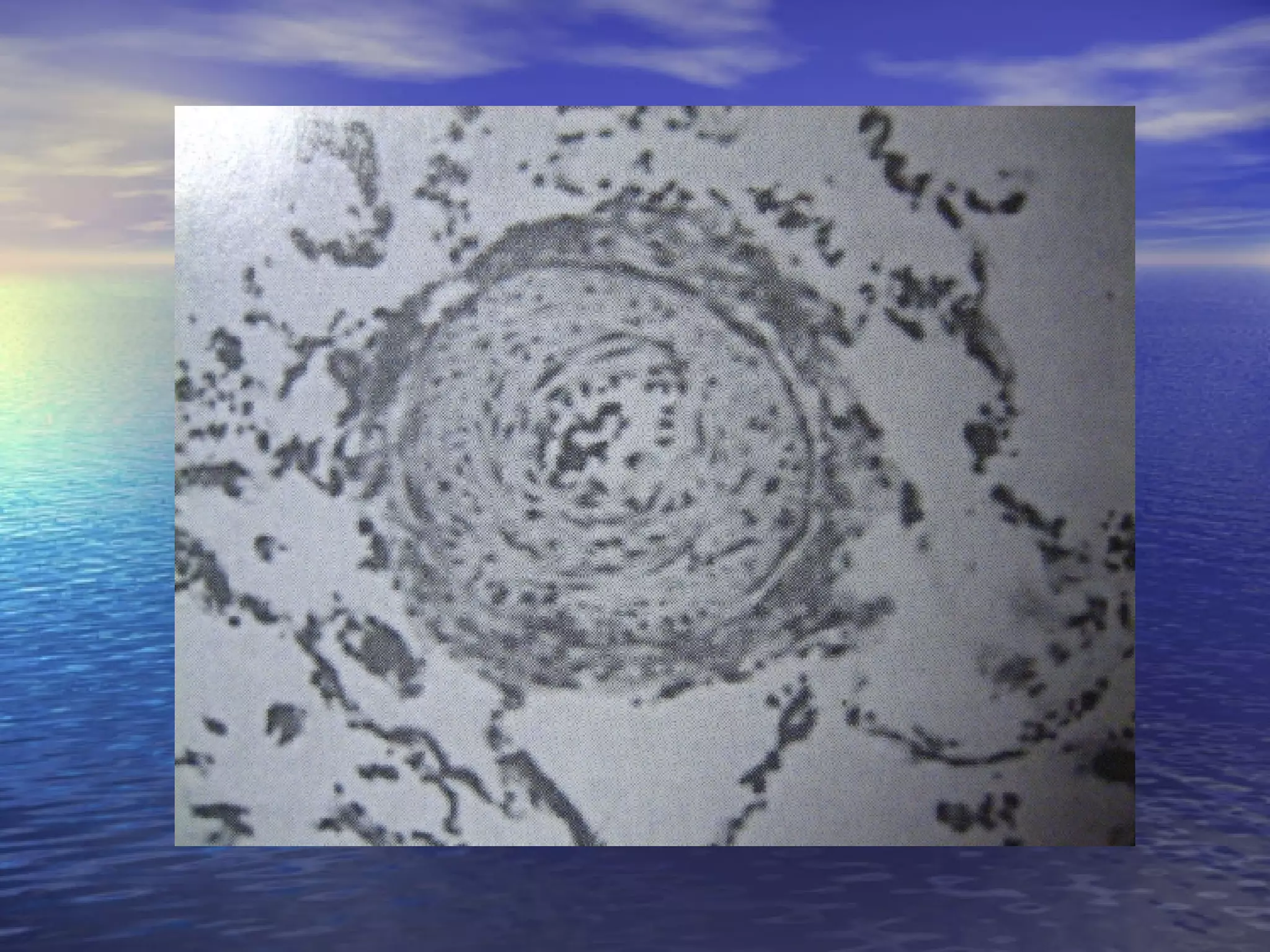 Mixed Connective Tissure Disease | PPT