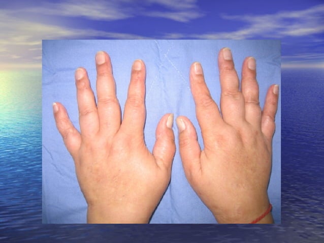 Mixed Connective Tissure Disease | PPT