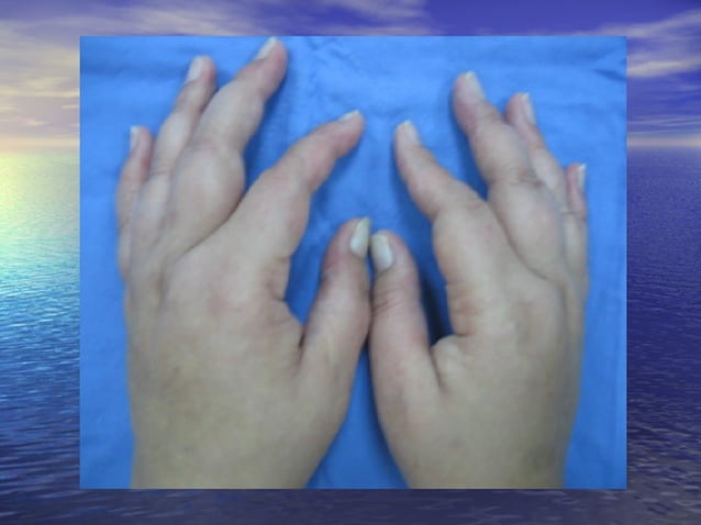 Mixed Connective Tissure Disease | PPT