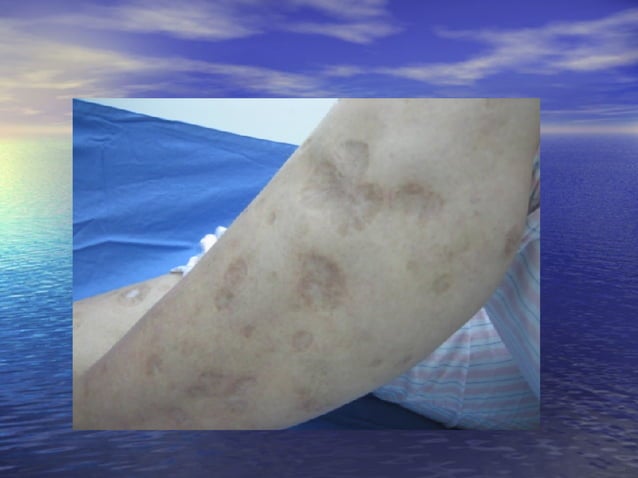 Mixed Connective Tissure Disease | PPT