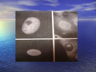 Mixed Connective Tissure Disease | PPT