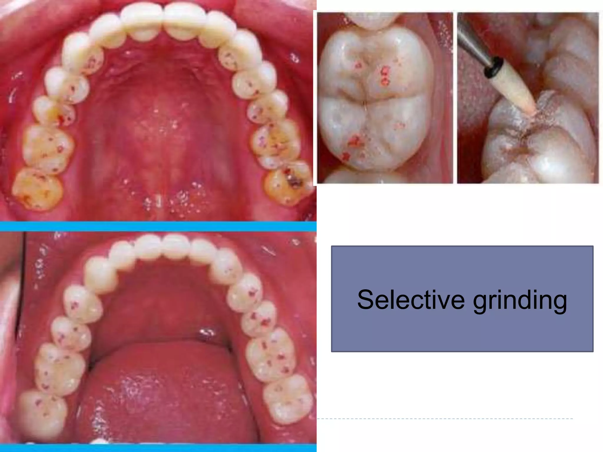 Introduction to Orthodontic treatment in Mixed dentition | PPTX