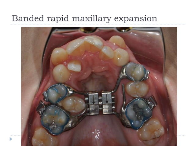 Introduction to Orthodontic treatment in Mixed dentition | PPTX