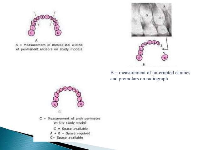 Mixed dentition analysis | PPTX | Dental Health | Diseases and Conditions