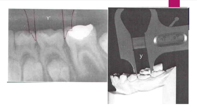 Mixed dentition analysis | PPTX