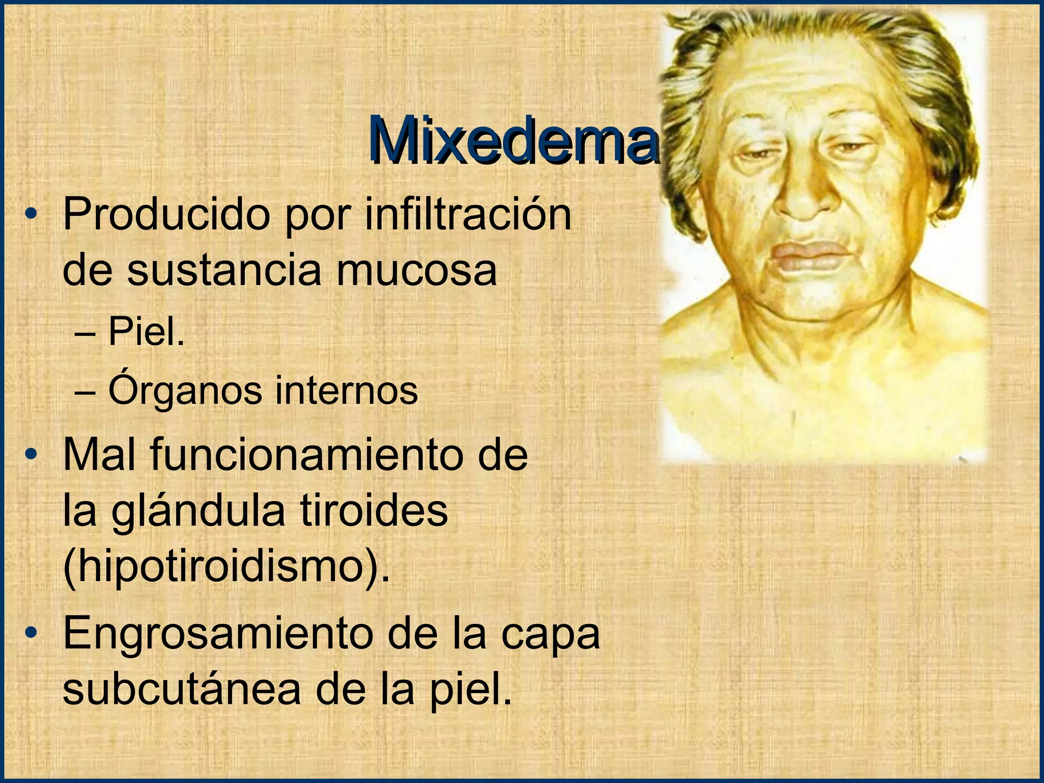 Mixedema