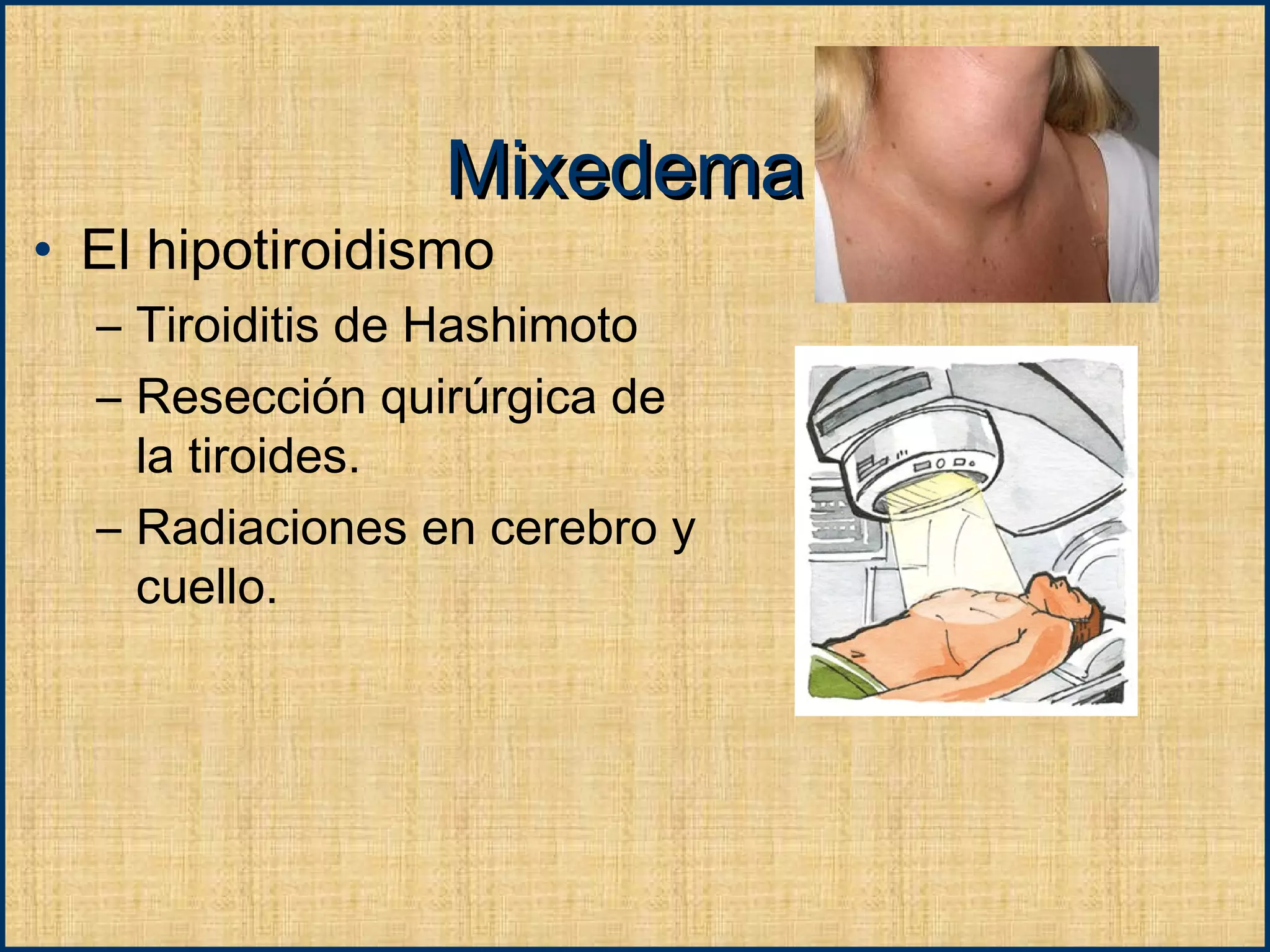 Mixedema