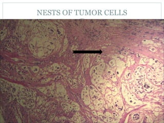 Mixed mucinous signet ring ca colon | PPTX