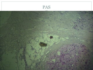 Mixed mucinous signet ring ca colon | PPTX