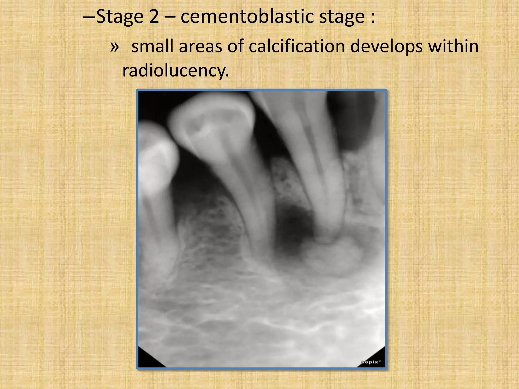 Mixed Radiopaque And Radiolucent Lesions Of Jaw Pptx