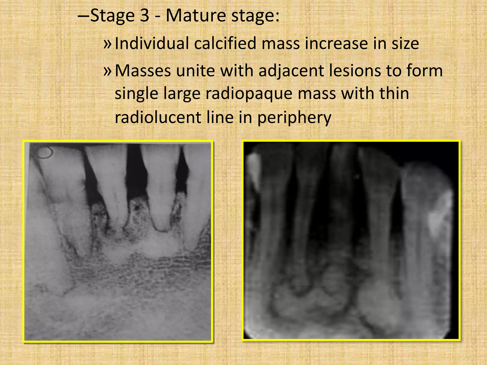 Mixed radiopaque & radiolucent lesions of jaw | PPTX